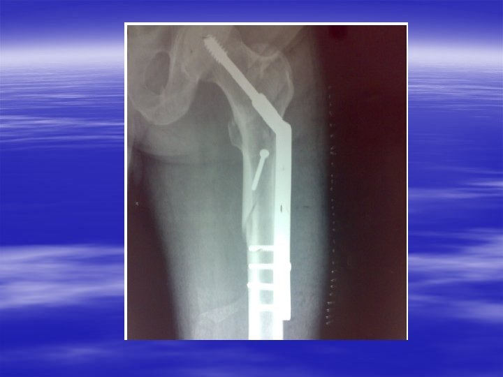 INDICATIONS FOR OPEN REDUCTIONS AND INTERNAL FIXATION OF