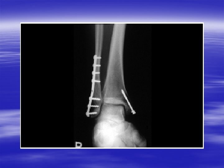 INDICATIONS FOR OPEN REDUCTIONS AND INTERNAL FIXATION OF