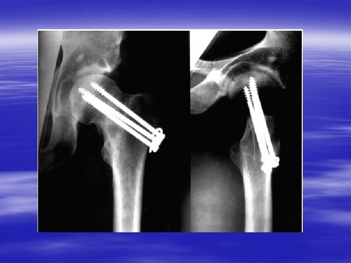 INDICATIONS FOR OPEN REDUCTIONS AND INTERNAL FIXATION OF