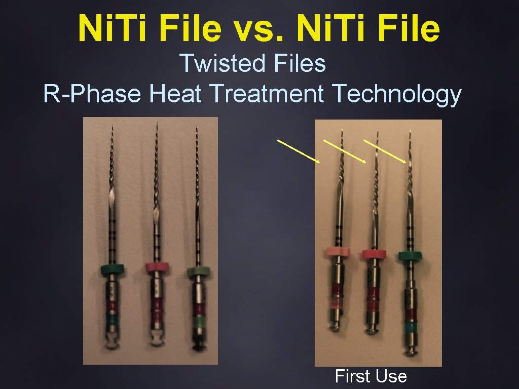 Bacterial Reduction With Progressive Filing Shupping 2000 Log