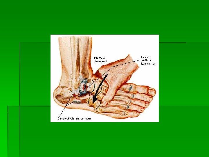 Ankle Injuries Ankle injuries fall into the same