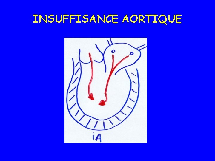 VALVULOPATHIES Rappel physiologique VALVULOPATHIES Dfinition maladie ...