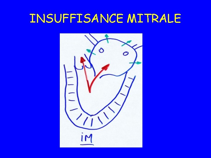 VALVULOPATHIES Rappel physiologique VALVULOPATHIES Dfinition maladie ...