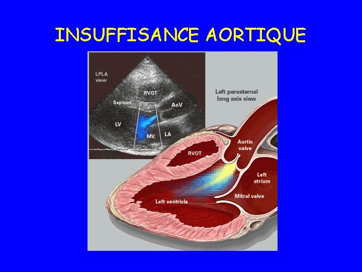 VALVULOPATHIES Rappel physiologique VALVULOPATHIES Dfinition maladie ...