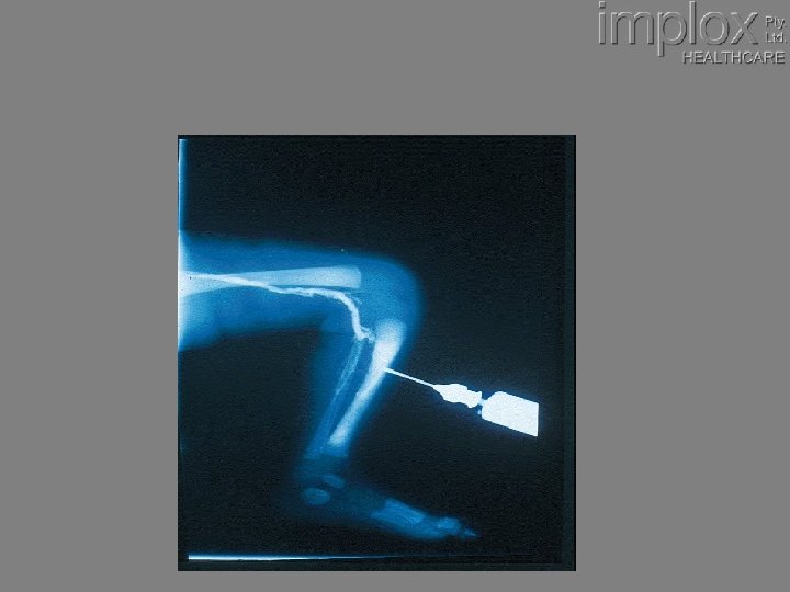 Per Sys Paediatric Bone Injection Gun B I