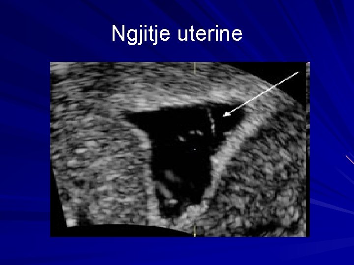 ANATOMIA RADIOLOGJIKE E UTERUSIT SISTEMI RIPRODHUES FEMEROR UTERUSI
