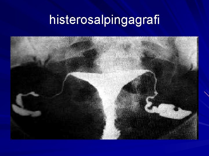 ANATOMIA RADIOLOGJIKE E UTERUSIT SISTEMI RIPRODHUES FEMEROR UTERUSI