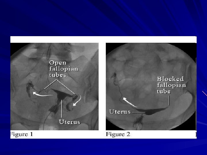 ANATOMIA RADIOLOGJIKE E UTERUSIT SISTEMI RIPRODHUES FEMEROR UTERUSI