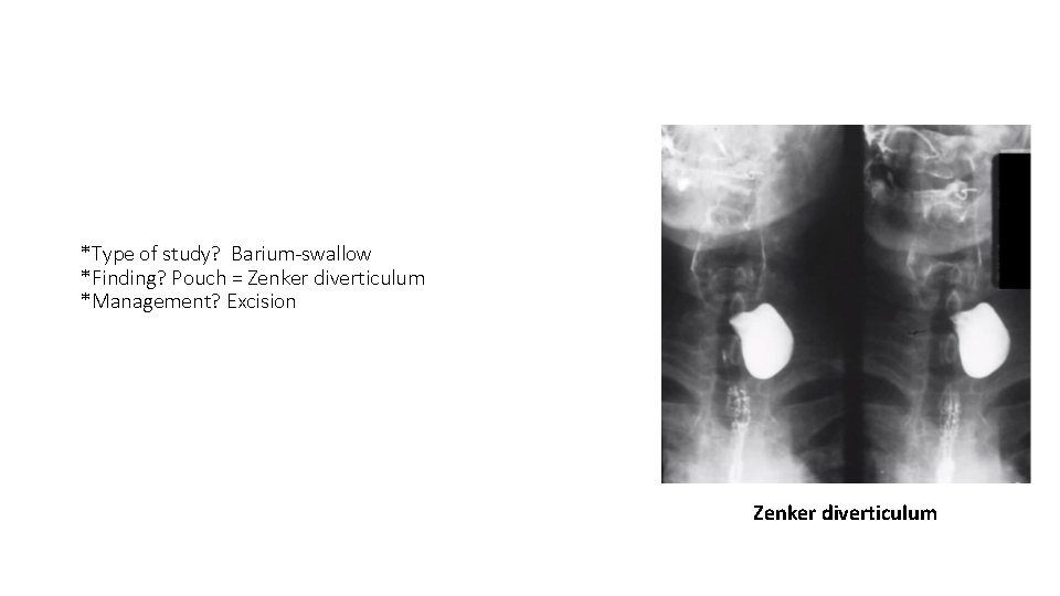 Abscess Management Open DrainNOT antibiotics Antibiotics after primary