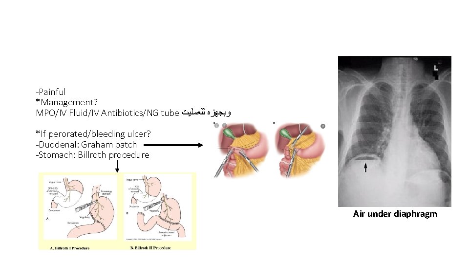 Abscess Management Open DrainNOT antibiotics Antibiotics after primary