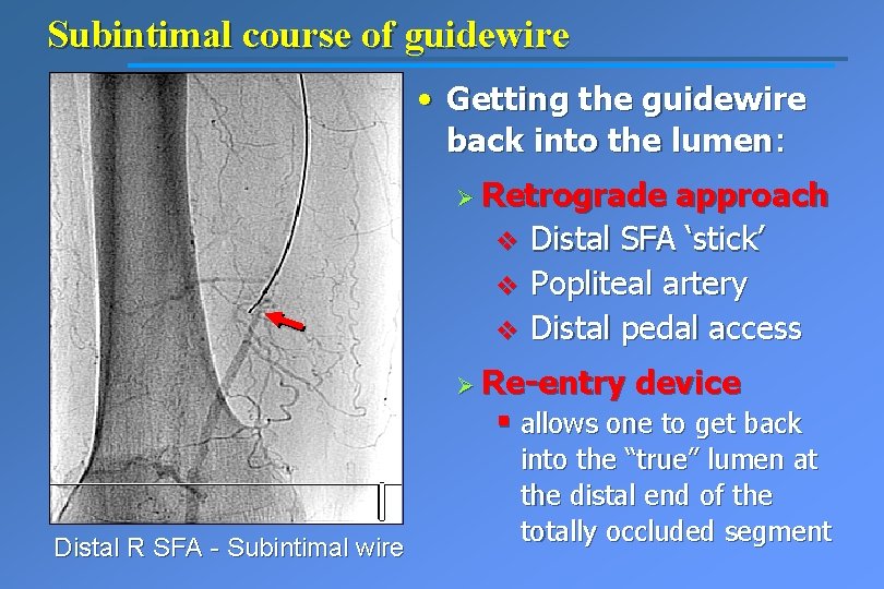 A Primer to Percutaneous Endovascular intervention ReEntry Devices