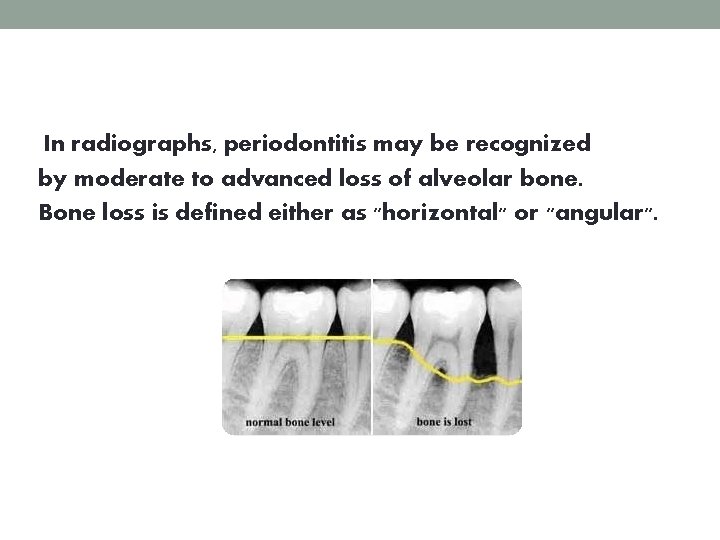 PERIODONTAL DISEASE DIAGNOSIS AND TREATMENT Dr Zahra Sohrabi