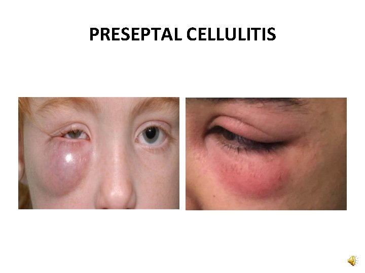 ORBIT PROPTOSIS BY PROF DR WASEEM AHMED KHAN