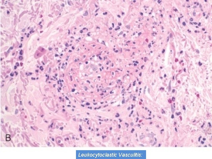 Vasculitis Shaesta Naseem Vasculitis Vascular inflammatory injury often