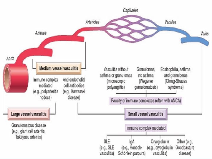 Vasculitis Shaesta Naseem Vasculitis Vascular inflammatory injury often