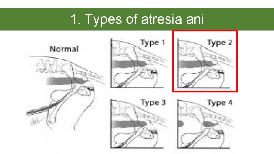 Surgical management of Atresia ani and Rectovaginal fistula