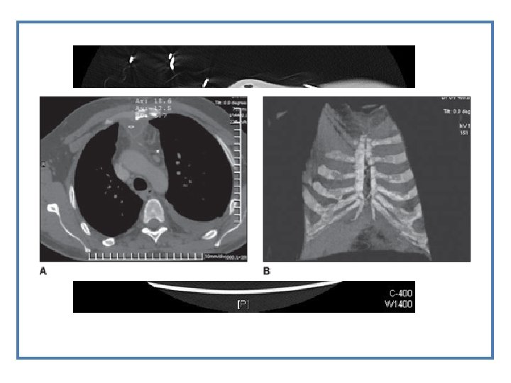 Incidencia y evolucin de la Deep sternal wound