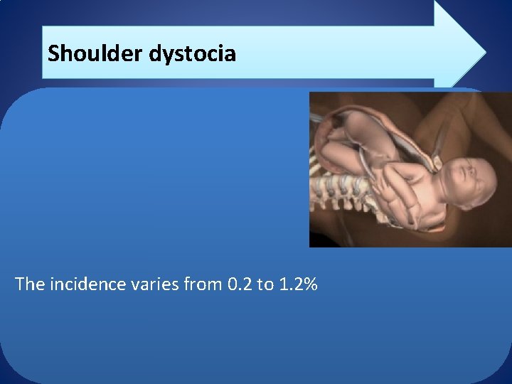 Shoulder dystocia Dr ban hadi Normal delivery When