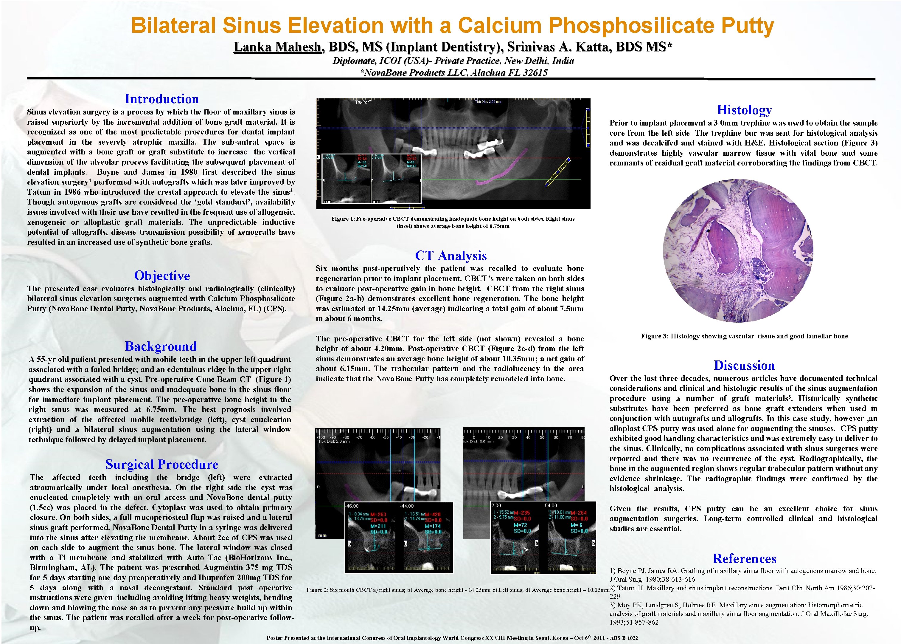Bilateral Sinus Elevation with a Calcium Phosphosilicate Putty