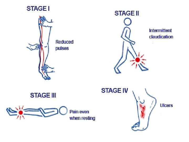 VENOUS ULCERS Venous ulcers Chronic skin and subcutaneous