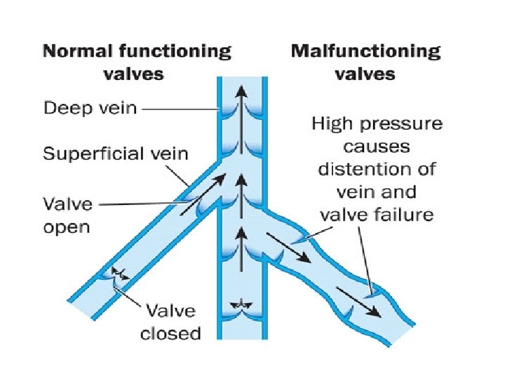 VENOUS ULCERS Venous ulcers Chronic skin and subcutaneous