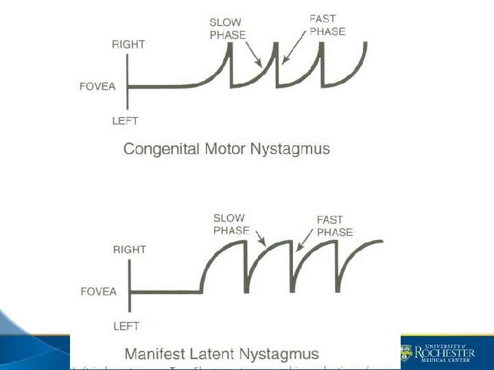 Pediatric Nystagmus Matthew D Gearinger MD Flaum Eye