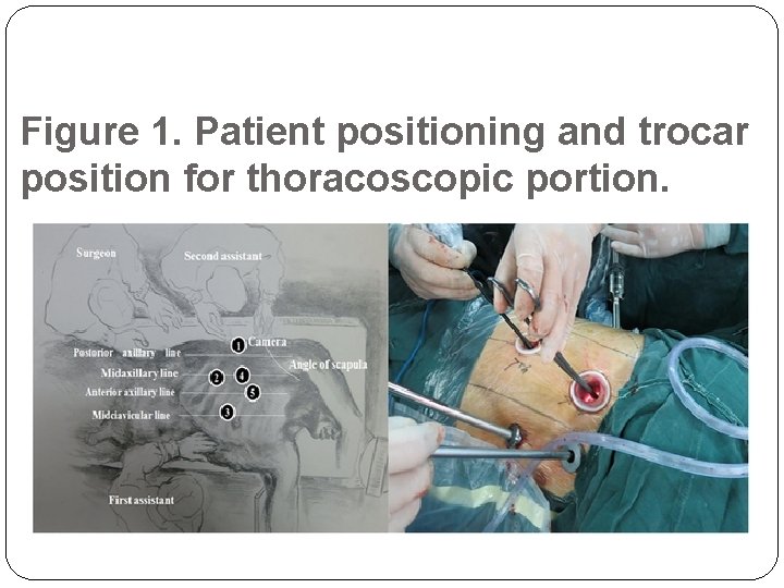 Figure 1 Patient positioning and trocar position for