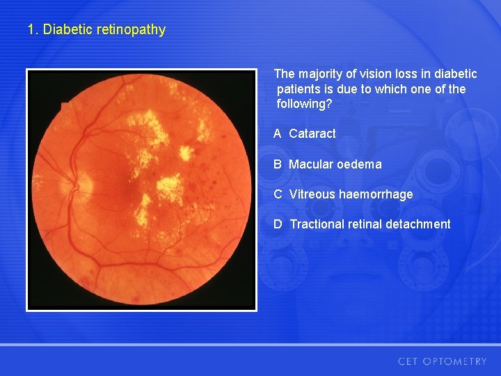 MCQ Picture Quiz Retina 1 1 Diabetic retinopathy