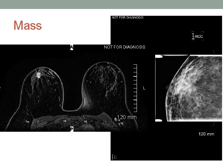 BREAST MRI As taught by a guy who
