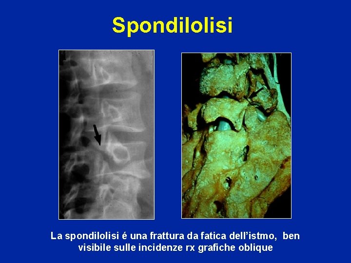 Spondilolistesi per lisi istmica Spondilolisi La spondilolisi una