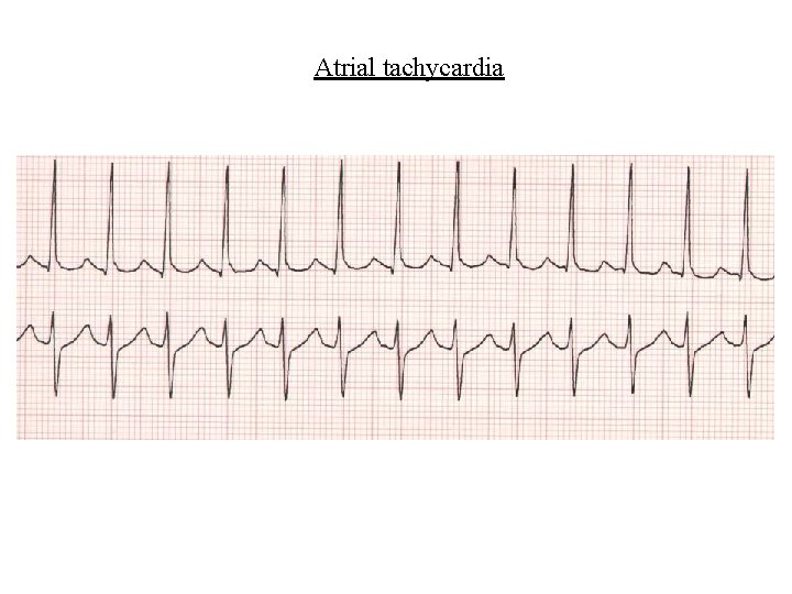 ARRHYTHMIAS Jamil Mayet Arrhythmias learning objectives Mechanisms of
