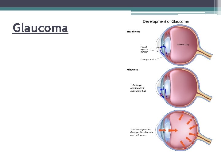 Glaucoma Cataracts Most common cause of vision loss