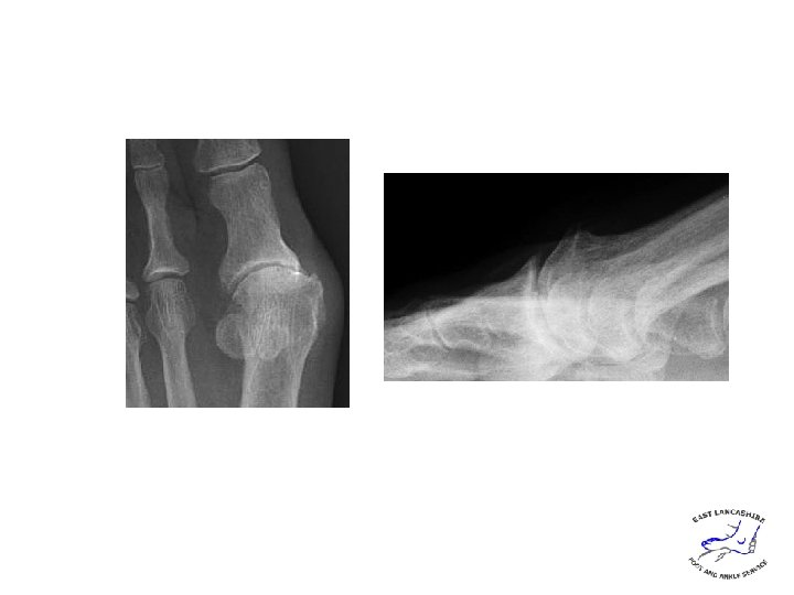Hallux rigidus Grading and nonsurgical treatment Jim Barrie
