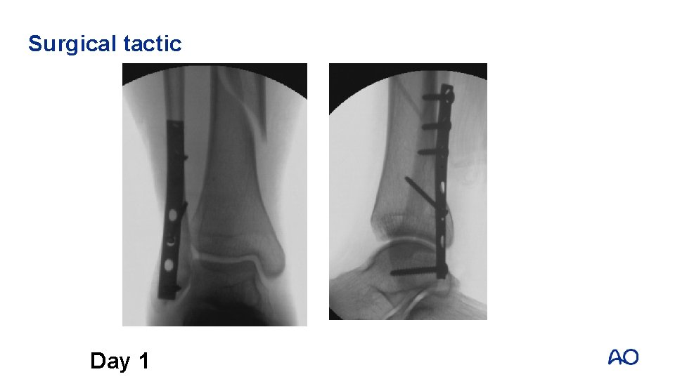 Extraarticular distal tibial fracture treated with a nail