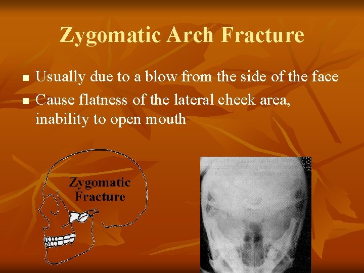 Facial and Mandibular Fractures Presented by M A