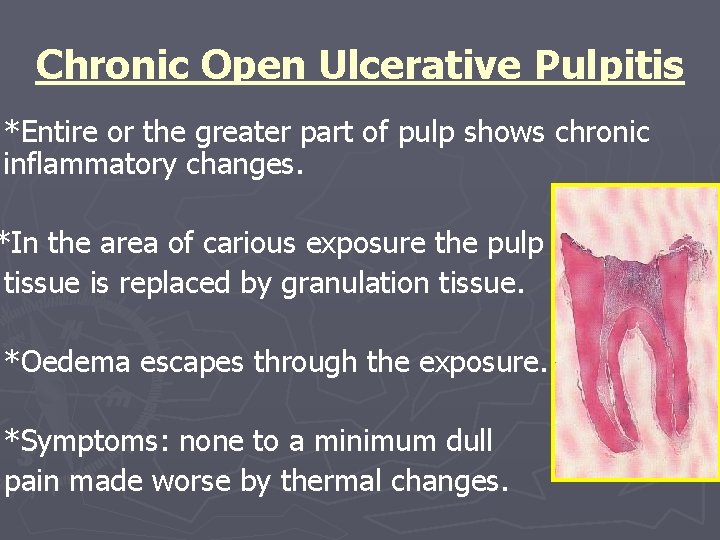Delicate Normal pulp connective tissue with tiny blood