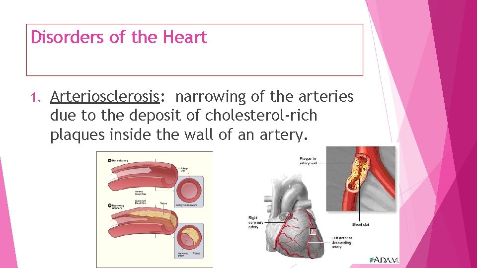 Disorders of the Heart 1 Arteriosclerosis narrowing of