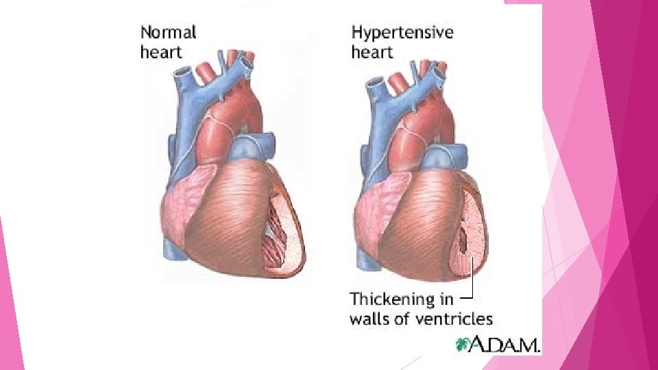 Disorders of the Heart 1 Arteriosclerosis narrowing of