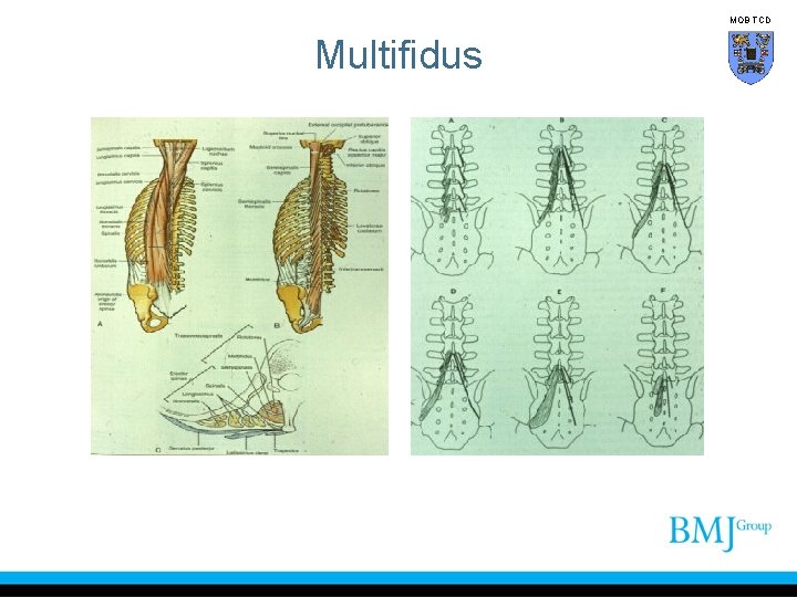 MOB TCD Spinal Muscles Professor Emeritus Moira OBrien
