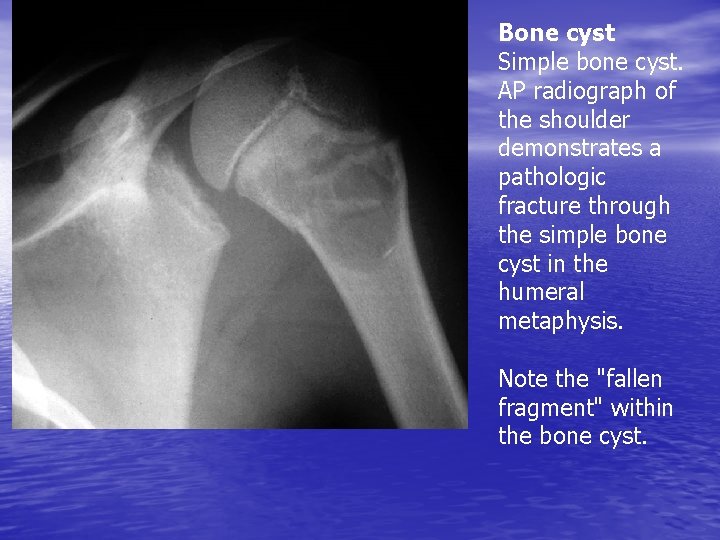 Tumor and Tumorlike Lesion of Bone Osteoma Osteoma