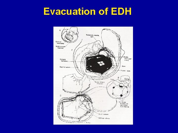 Traumatic Brain Injury Jason A Demery Ph D