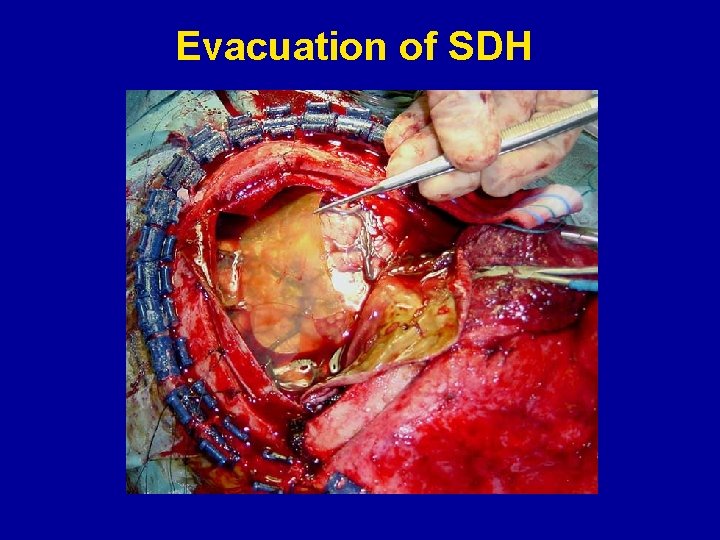 Traumatic Brain Injury Jason A Demery Ph D