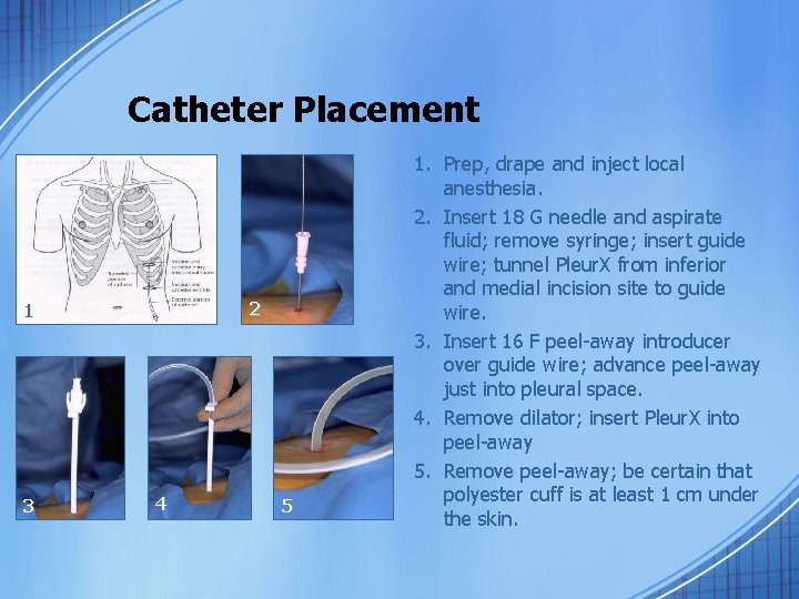 Malignant Pleural Effusions Treatment with Indwelling Pleural Catheter
