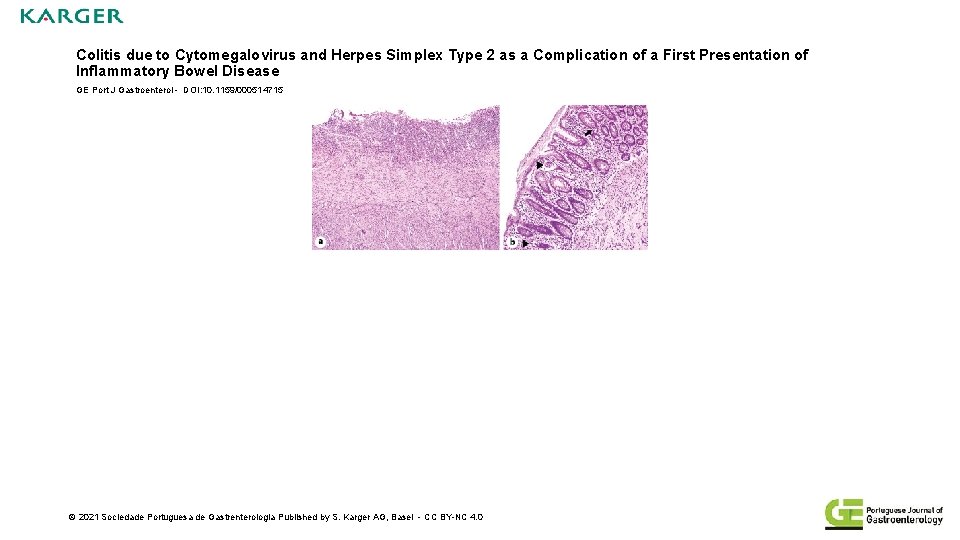 Colitis due to Cytomegalovirus and Herpes Simplex Type