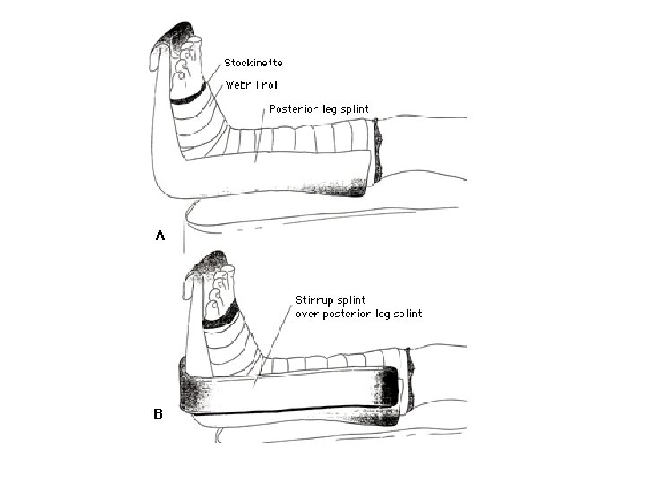 Splinting Immobilization Learning Objectives Appropriate immobilization ...