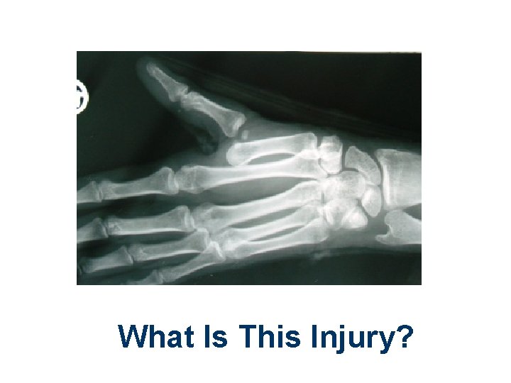 Splinting Immobilization Learning Objectives Appropriate immobilization ...