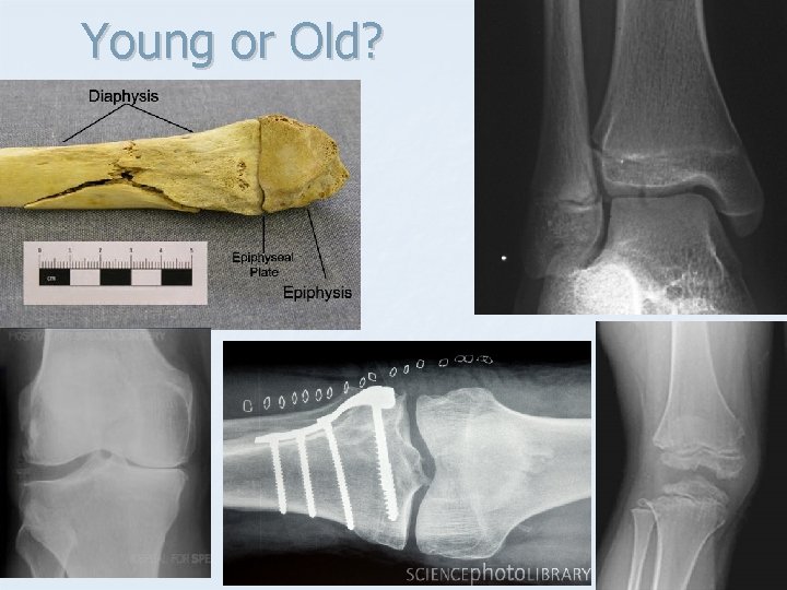 Determining Age using Bones Notes on page 103