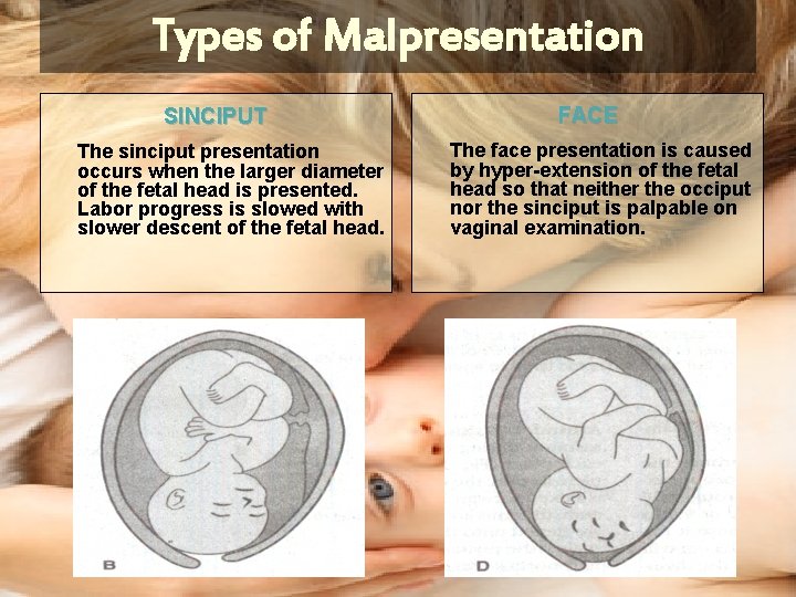 Types of Malpresentation TRANSVERSE In a transverse lie