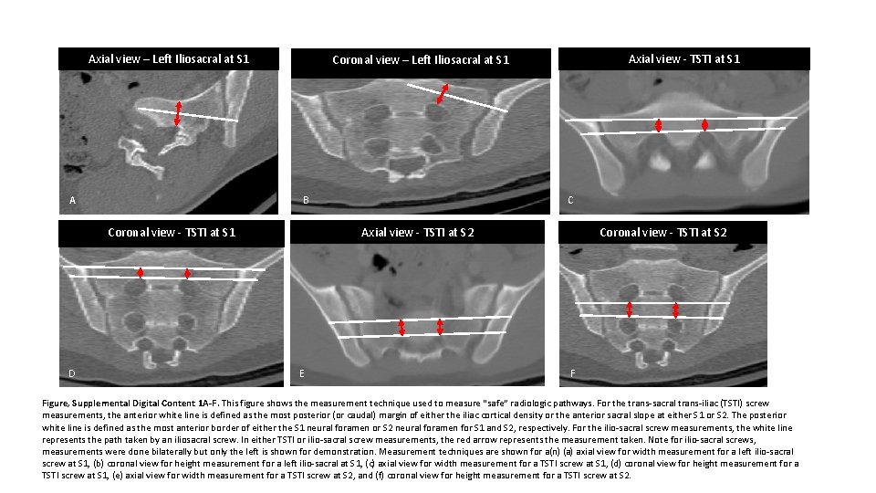 Axial view Left Iliosacral at S 1 B