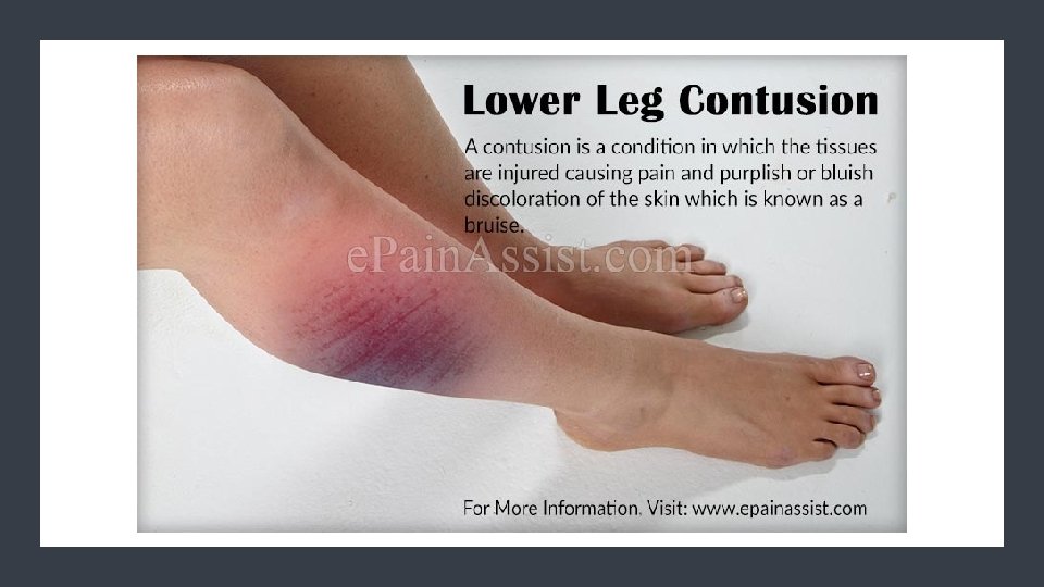 LIGAMENT INJURIES LATERAL AND MEDIAL ANKLE SPRAINS ABOUT